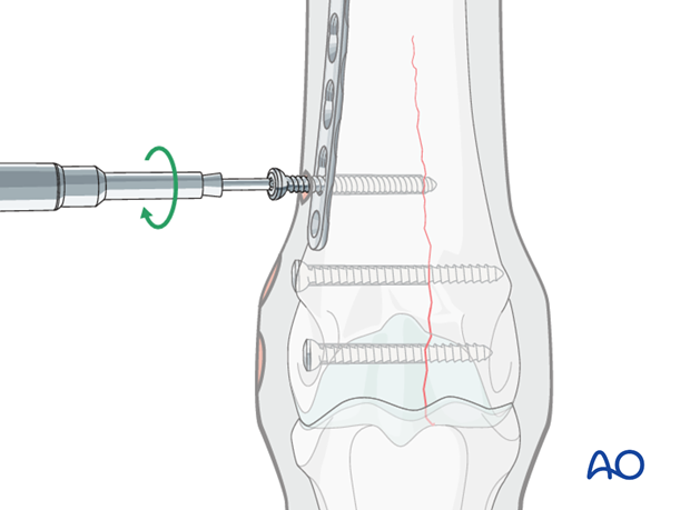 Plate fixation for Medial condyle incomplete fractures