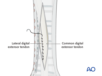 Dorsolateral approach for medial condylar fractures