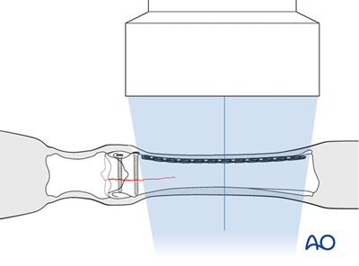 Plate fixation for Medial condyle incomplete fractures