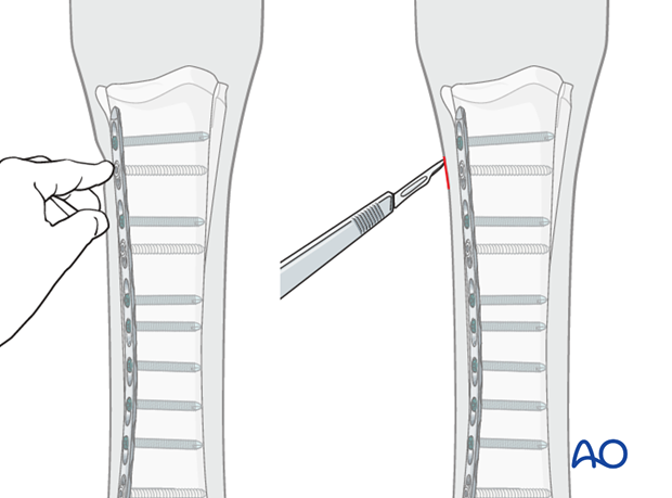 Plate fixation for Medial condyle spiral fractures