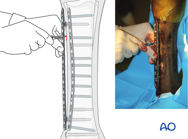 Plate fixation for Medial condyle spiral fractures