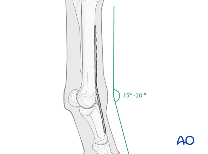 Arthrodesis: tension bad using wires or the sesamoid bones for Fetlock ...