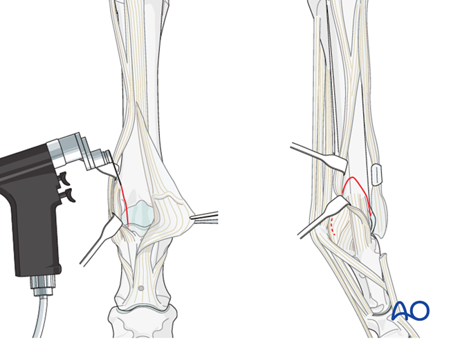 Arthordesis: tension band for Fetlock joint disruption