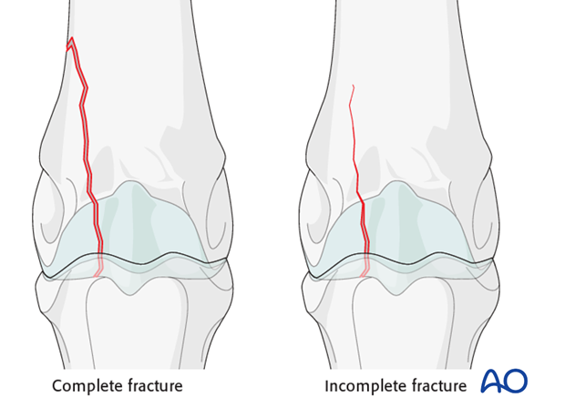 Lateral condyle nondisplaced fractures