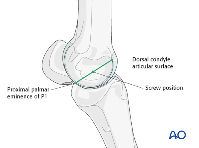 Screw fixation for Lateral condyle displaced fractures