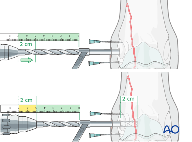 Screw fixation for Lateral condyle nondisplaced fractures