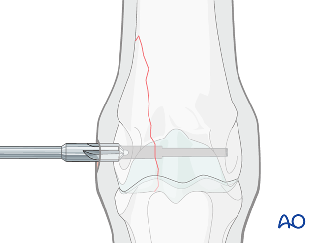 Screw fixation for Lateral condyle nondisplaced fractures
