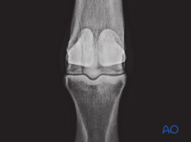 Lateral condyle nondisplaced fractures