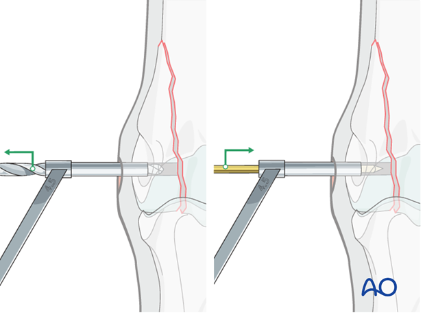 Screw fixation for Lateral condyle displaced fractures