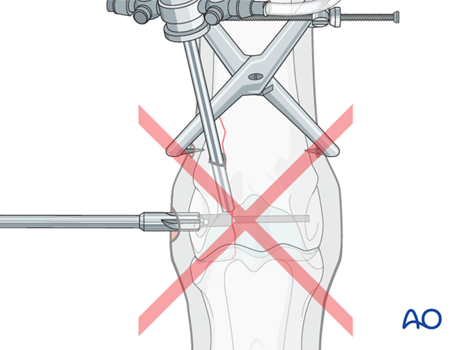 Screw fixation for Lateral condyle displaced fractures