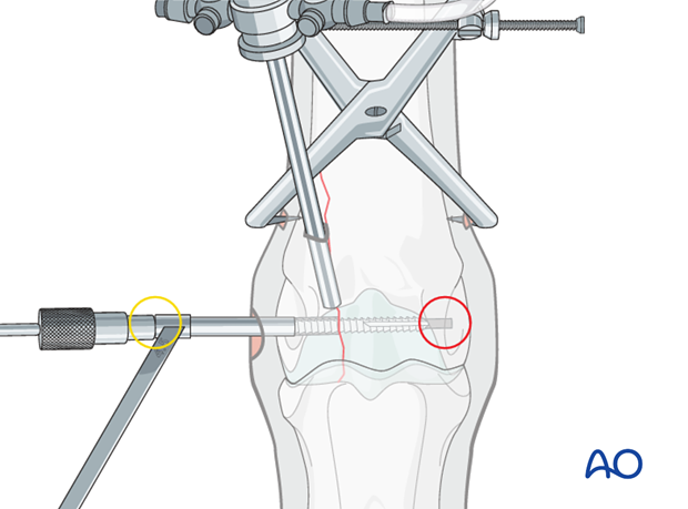 Screw fixation for Lateral condyle displaced fractures