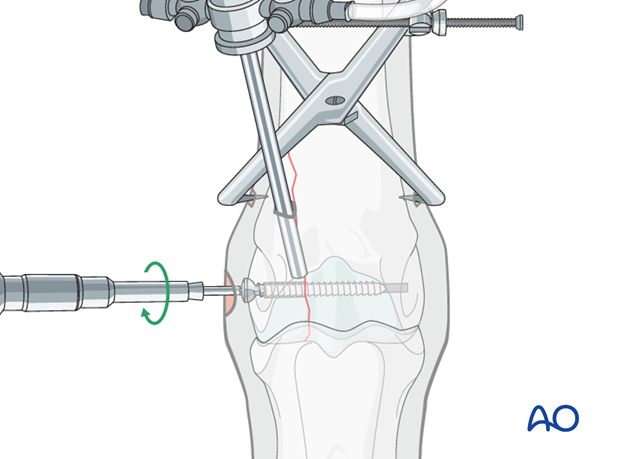 Screw fixation for Lateral condyle displaced fractures