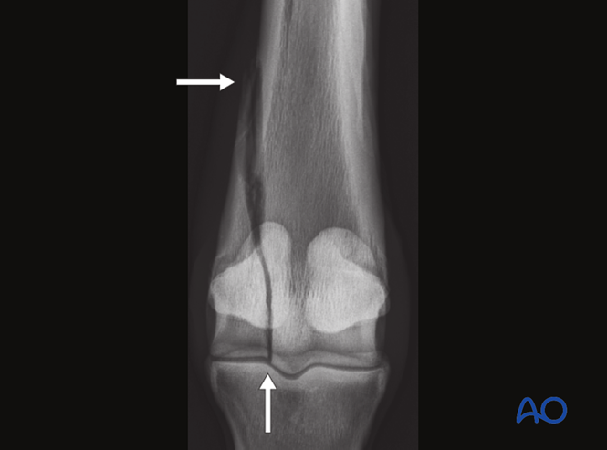 Lateral condyle displaced fractures