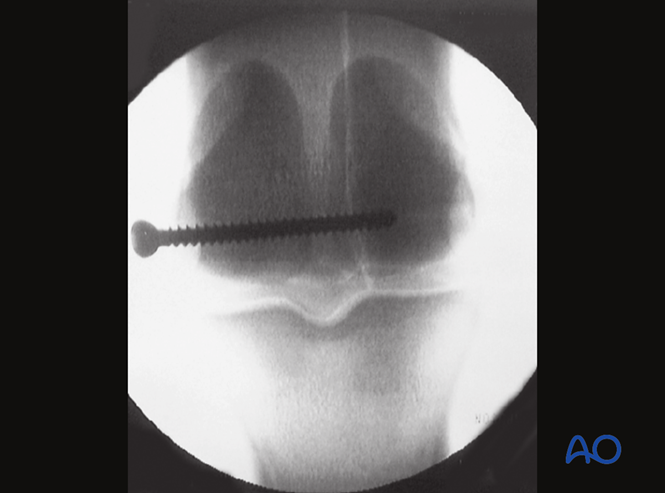 Screw fixation for Lateral condyle displaced fractures