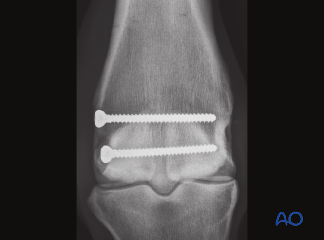 Screw fixation for Lateral condyle displaced fractures