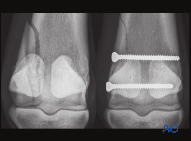 Screw fixation for Lateral condyle displaced fractures