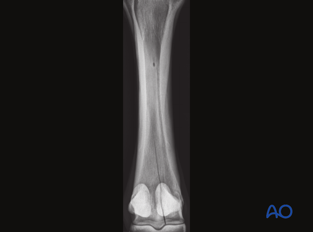 Medial condyle incomplete fractures