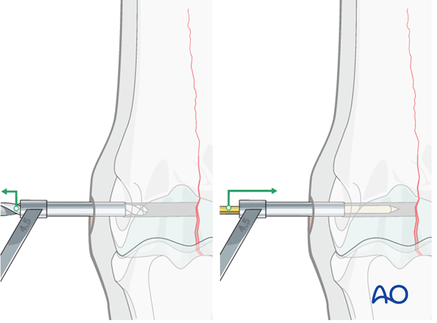 Screw fixation under general anesthesia for Medial condyle incomplete ...