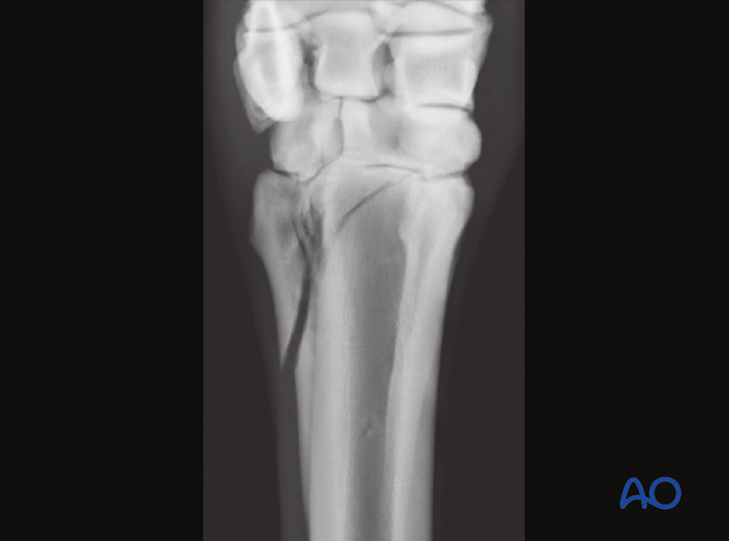 Metacarpals/-tarsals II and IV: Proximal fractures
