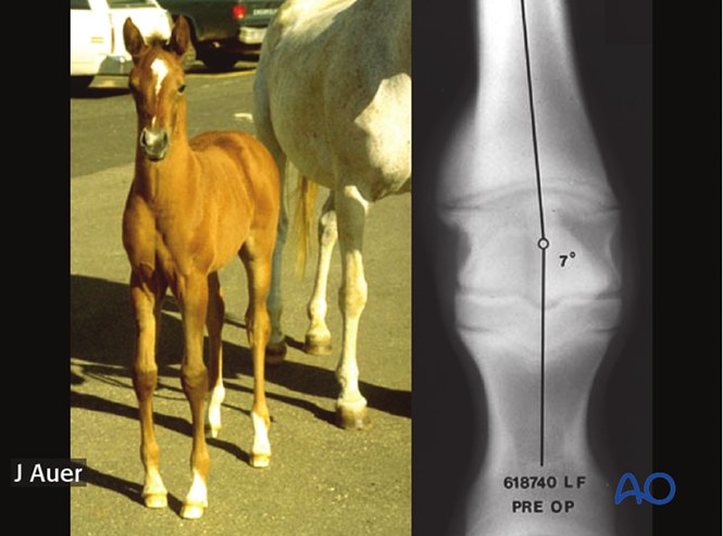 Angular limb deformities