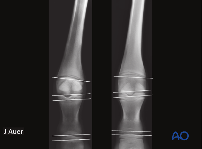 Angular limb deformities
