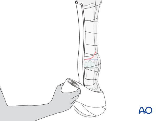Screws with transphyseal bridge for Metacarpals/-tarsals III ...