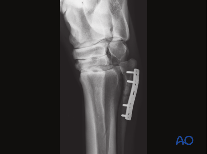 Plate fixation for Metacarpals/-tarsals II and IV: Proximal fractures