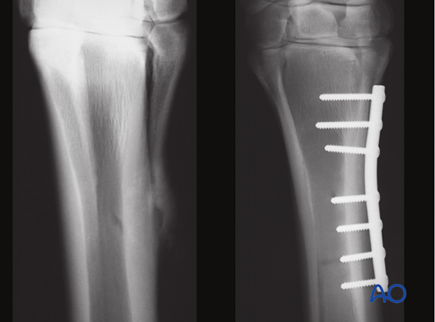 Plate fixation for Metacarpals/-tarsals II and IV: Proximal fractures