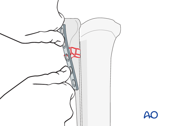 Plate fixation for Metacarpals/-tarsals II and IV: Proximal fractures
