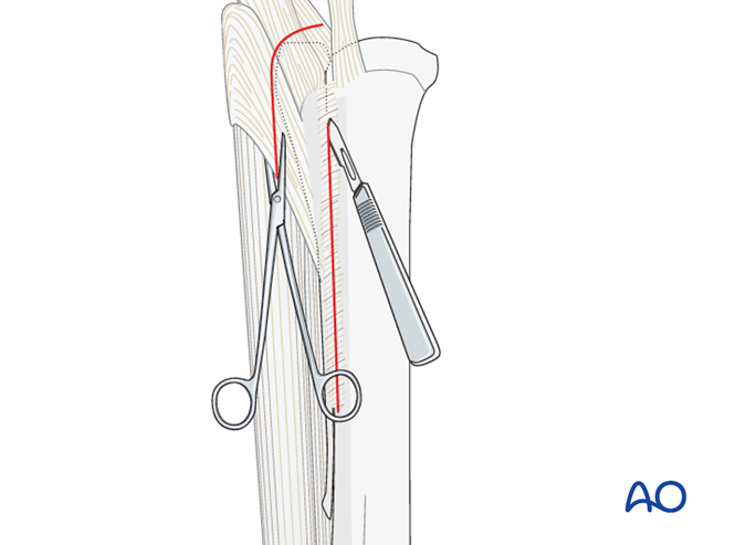 Resection for Metacarpals/-tarsals II and IV: Proximal fractures