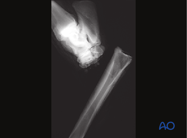 Resection for Metacarpals/-tarsals II and IV: Proximal fractures