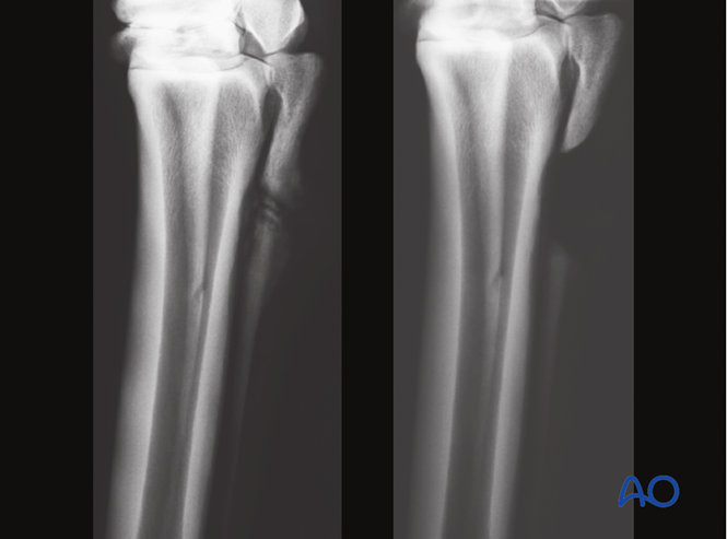 Resection for Metacarpals/-tarsals II and IV: Proximal fractures
