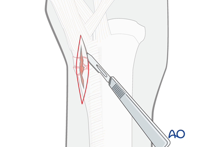 Approaches to the splint bones