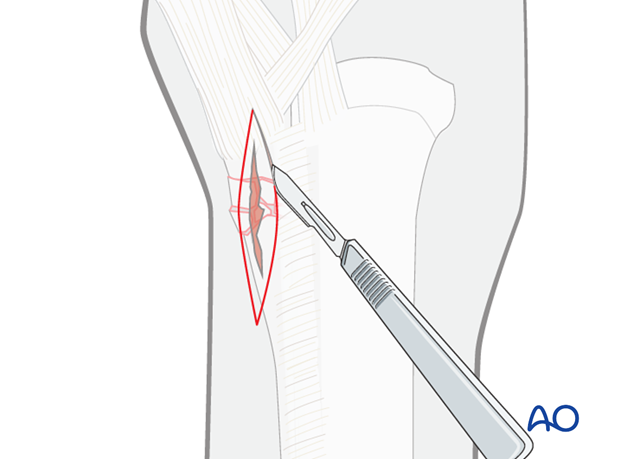 Approaches to the splint bones