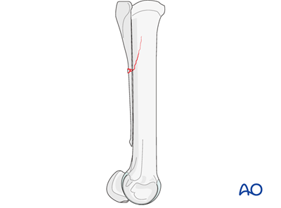 Metacarpals/-tarsals II and IV: Midbody fractures