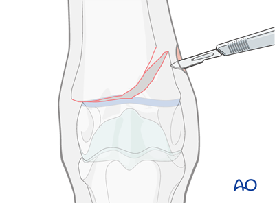 Screws with transphyseal bridge for Metacarpals/-tarsals III ...