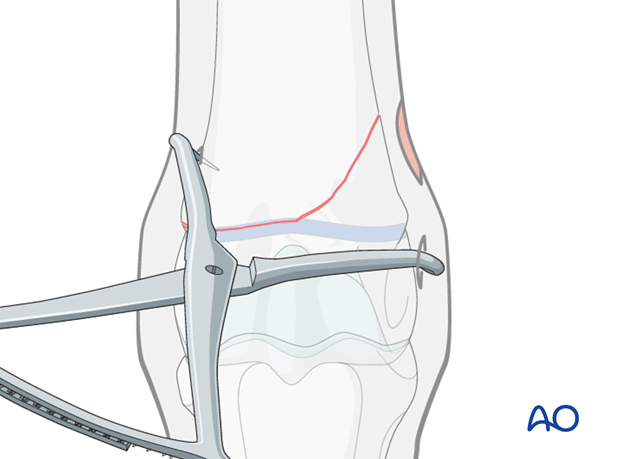 Screws with transphyseal bridge for Metacarpals/-tarsals III ...