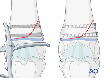 Screws with transphyseal bridge for Metacarpals/-tarsals III ...