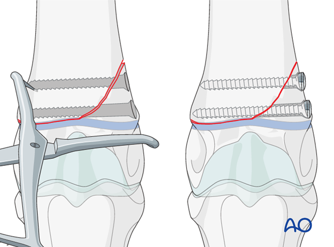 Screws with transphyseal bridge for Metacarpals/-tarsals III ...