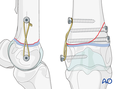 Screws with transphyseal bridge for Metacarpals/-tarsals III ...