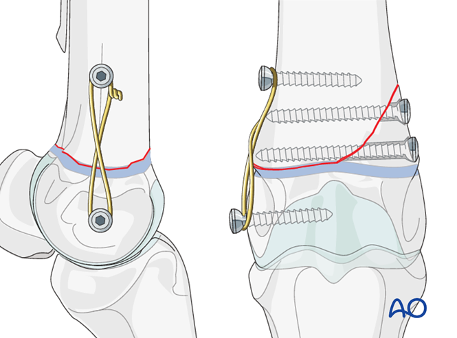 Screws with transphyseal bridge for Metacarpals/-tarsals III ...