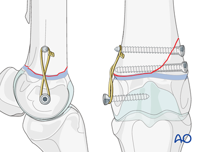 Screws with transphyseal bridge for Metacarpals/-tarsals III ...