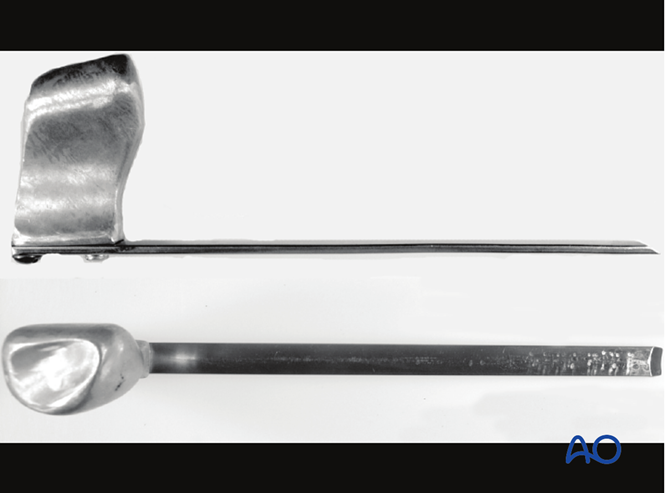 Plate fixation for Medial condyle incomplete fractures