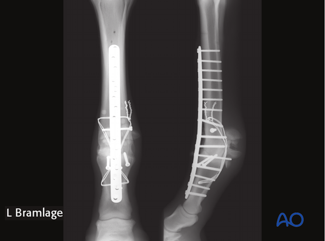 Arthordesis: tension band for Fetlock joint disruption