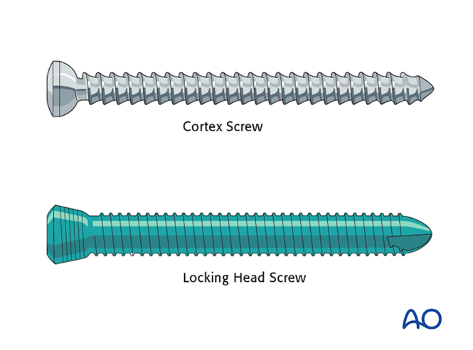 Double plating for Metacarpals/-tarsals III: Distal simple fractures