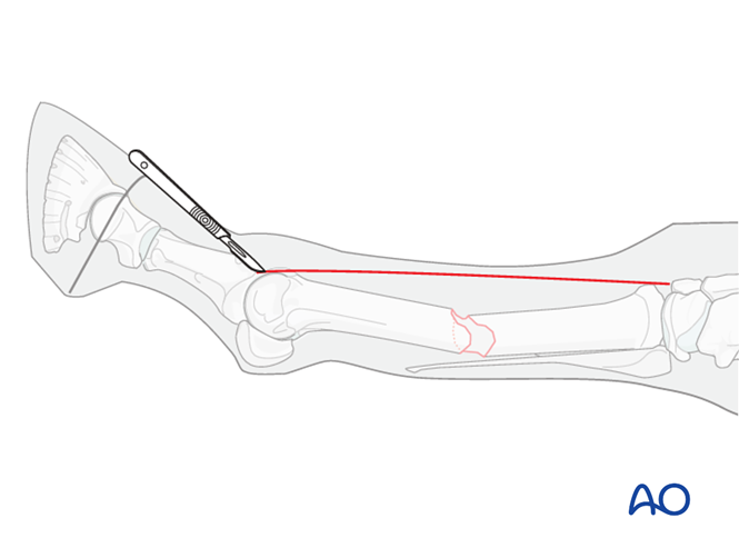 Double plating for Metacarpals/-tarsals III: Distal simple fractures
