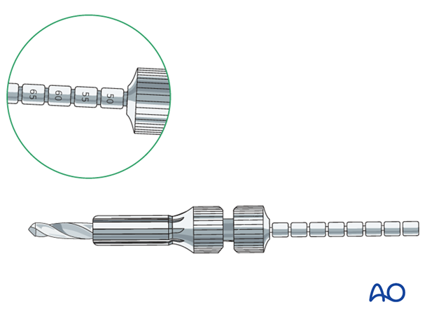 Double plating for Metacarpals/-tarsals III: Distal simple fractures