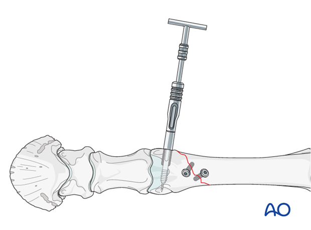 Double plating for Metacarpals/-tarsals III: Distal simple fractures