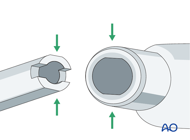 Double plating for Metacarpals/-tarsals III: Distal simple fractures