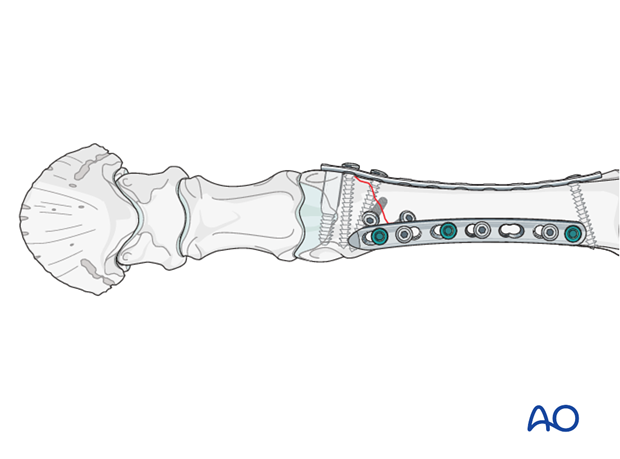 Double plating for Metacarpals/-tarsals III: Distal simple fractures